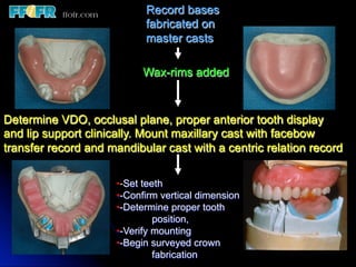 12.surveyed crowns and combined fixed rpd cases | PDF