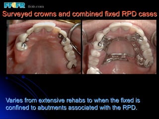 12.surveyed crowns and combined fixed rpd cases | PDF