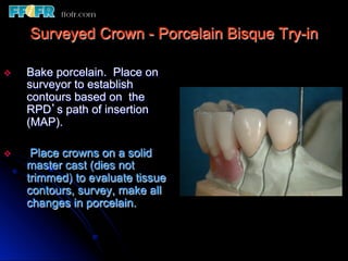 12.surveyed crowns and combined fixed rpd cases | PDF