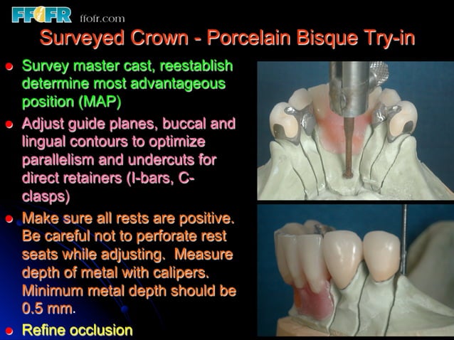 12.surveyed crowns and combined fixed rpd cases | PDF