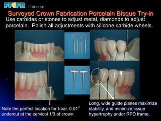 12.surveyed crowns and combined fixed rpd cases | PDF
