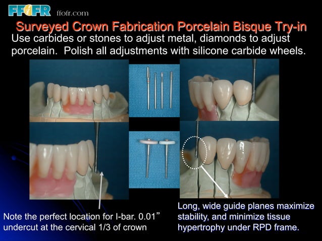 12.surveyed crowns and combined fixed rpd cases | PDF