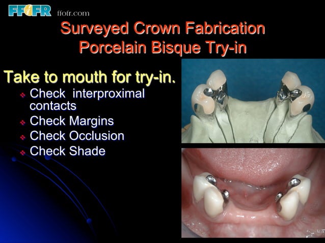 12.surveyed crowns and combined fixed rpd cases | PDF