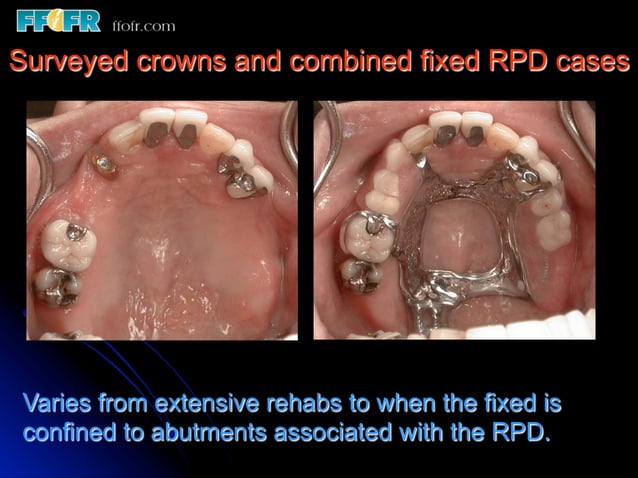 12.surveyed crowns and combined fixed rpd cases | PDF