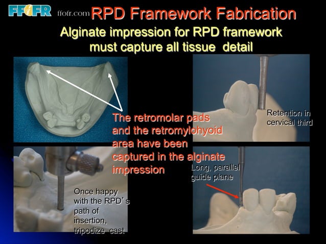 12.surveyed crowns and combined fixed rpd cases | PDF