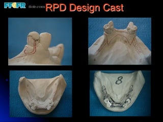 12.surveyed crowns and combined fixed rpd cases | PDF