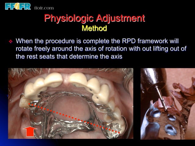 12.surveyed crowns and combined fixed rpd cases | PDF