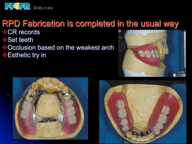 12.surveyed crowns and combined fixed rpd cases | PDF
