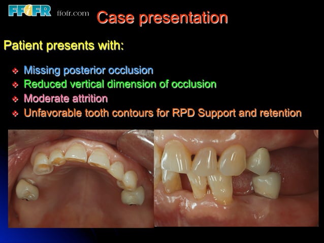 12.surveyed crowns and combined fixed rpd cases | PPT