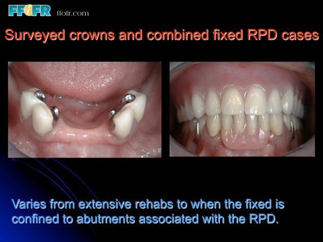 12.surveyed crowns and combined fixed rpd cases | PDF