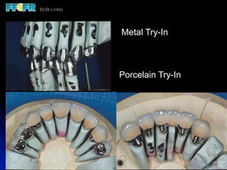 12.surveyed crowns and combined fixed rpd cases | PDF