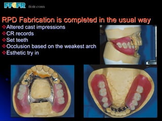 12.surveyed crowns and combined fixed rpd cases | PDF