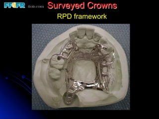 12.surveyed crowns and combined fixed rpd cases | PDF