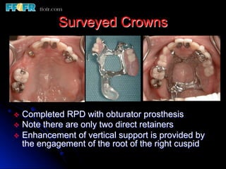 12.surveyed crowns and combined fixed rpd cases | PDF