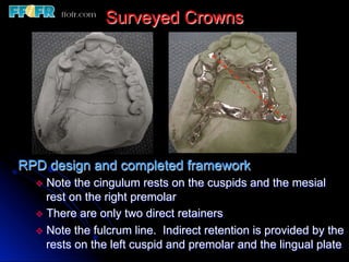 12.surveyed crowns and combined fixed rpd cases | PDF