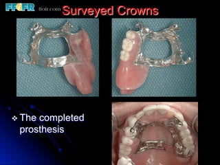 12.surveyed crowns and combined fixed rpd cases | PDF
