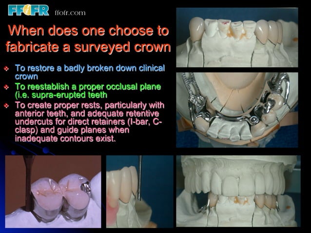12.surveyed crowns and combined fixed rpd cases | PDF