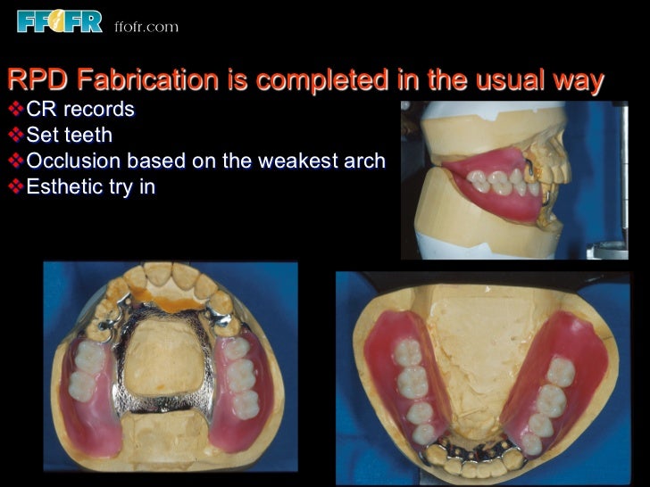 12.surveyed crowns and combined fixed rpd cases