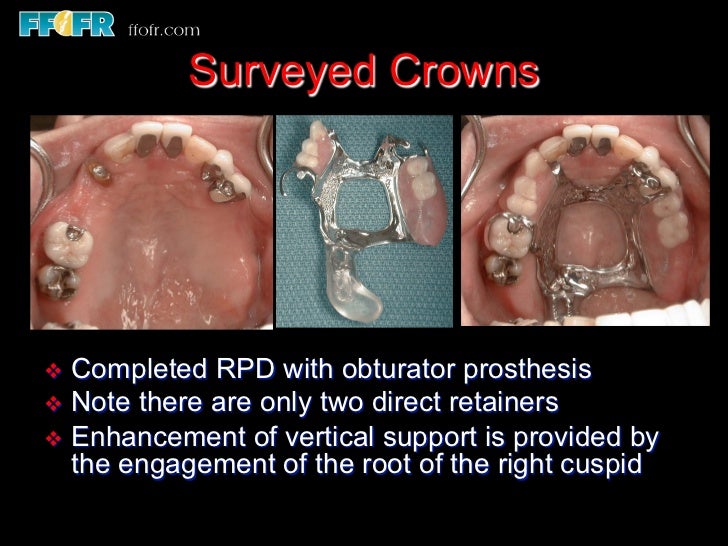 12.surveyed crowns and combined fixed rpd cases