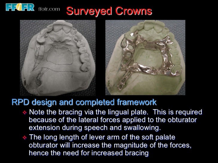 12.surveyed crowns and combined fixed rpd cases