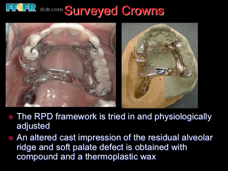12.surveyed crowns and combined fixed rpd cases