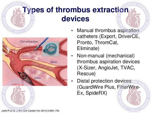 Intraluminal coronary thrombus aspiration in patients with STEMI. Pro…