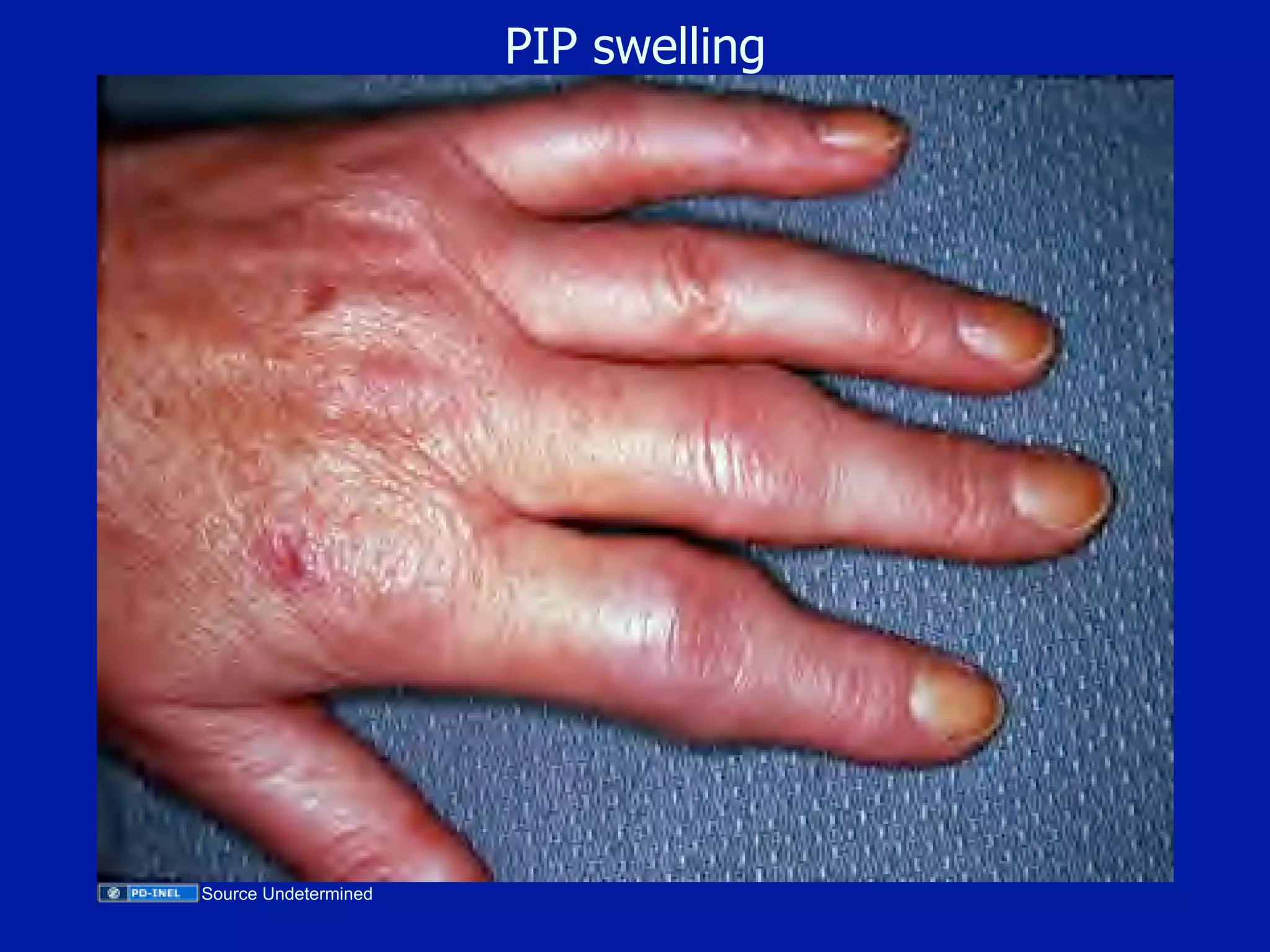 12.01.08(a): Rheumatoid Arthritis/Pathogenesis and Clinical ...