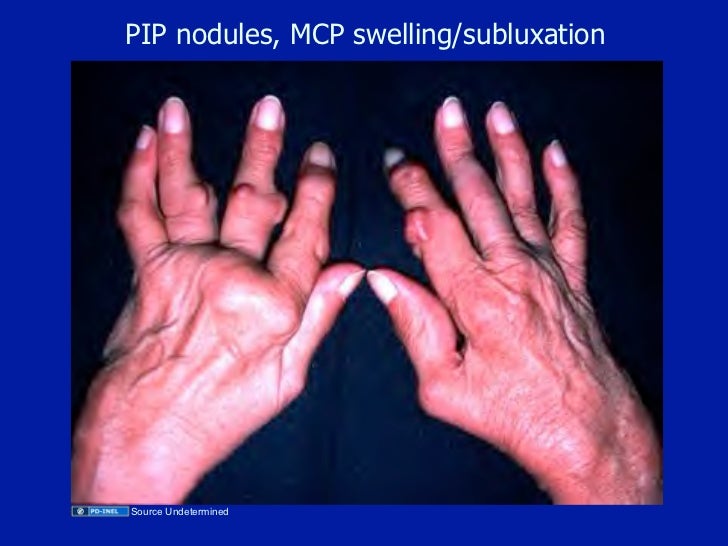 12.01.08(a): Rheumatoid Arthritis/Pathogenesis and Clinical Presentat…