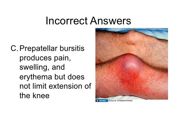 12.02.09(a): Other Inflammatory Arthritides