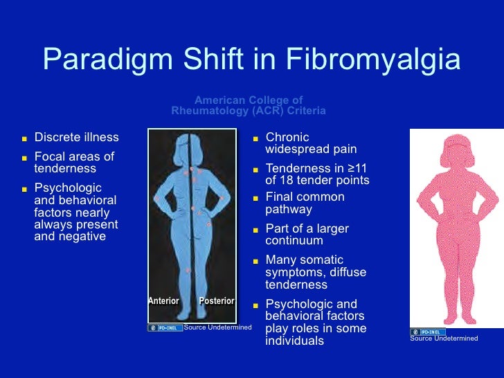 12.04.08(a): Pathogenesis and Treatment of Fibromyalgia