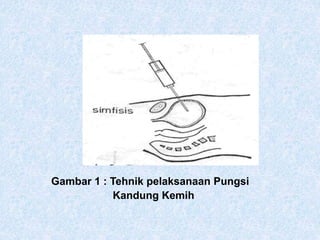 12047606asdasd5-Infeksi-Saluran-Kemih.ppt