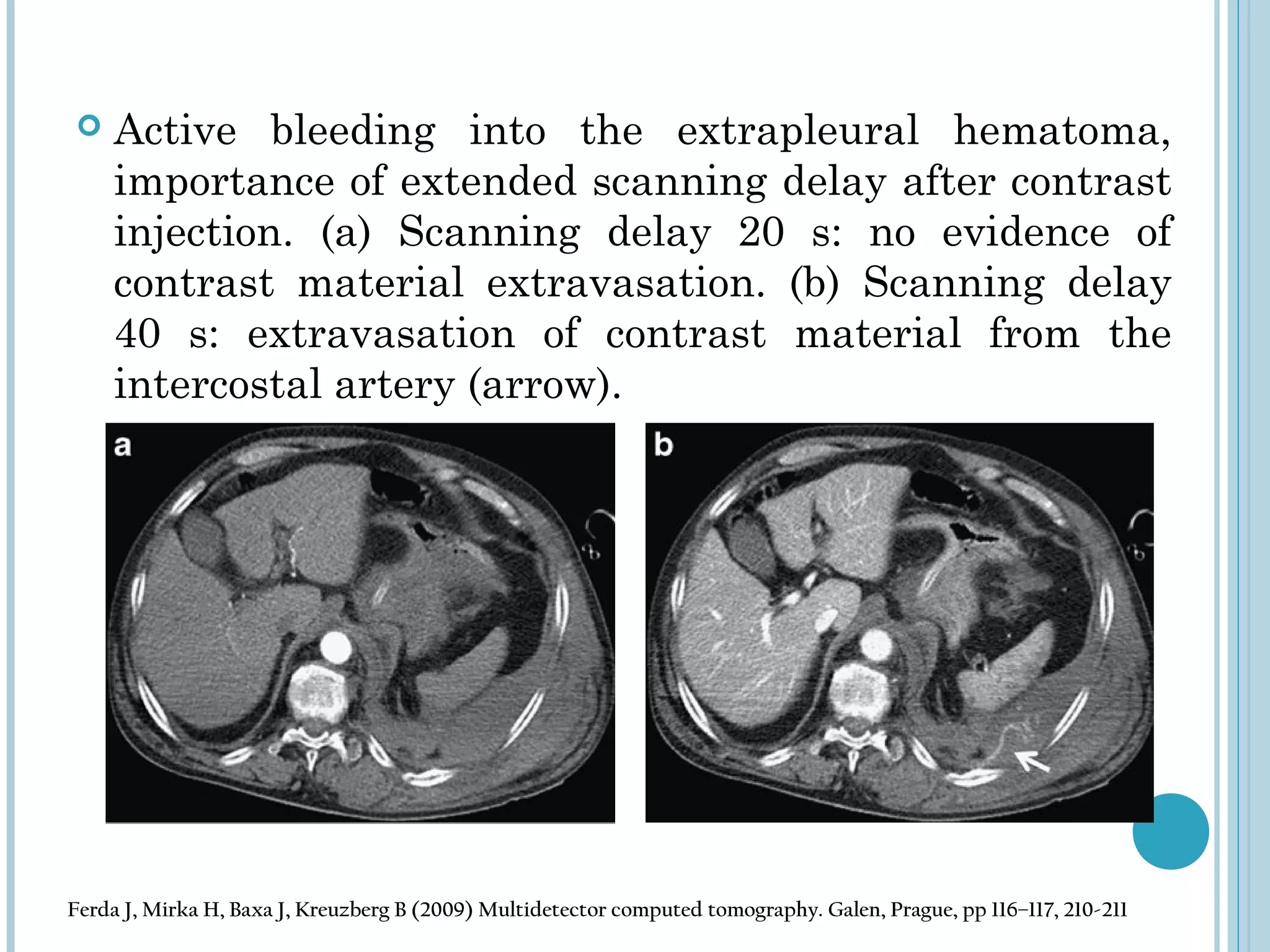 12100053 pulmonary contusion | PPT