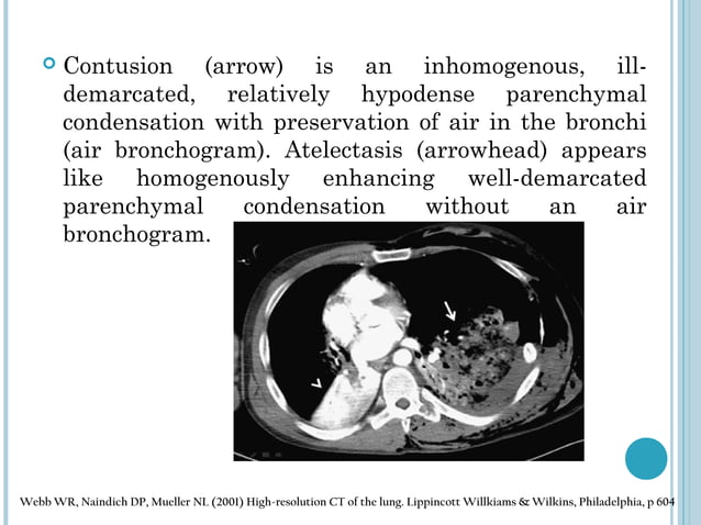 12100053 pulmonary contusion | PPT