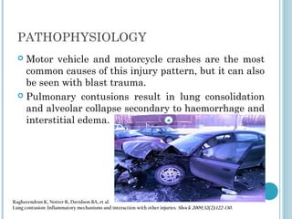 12100053 pulmonary contusion | PPT