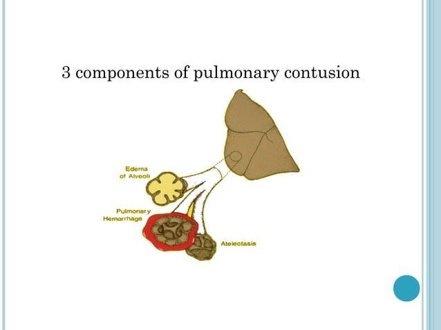 12100053 pulmonary contusion | PPT