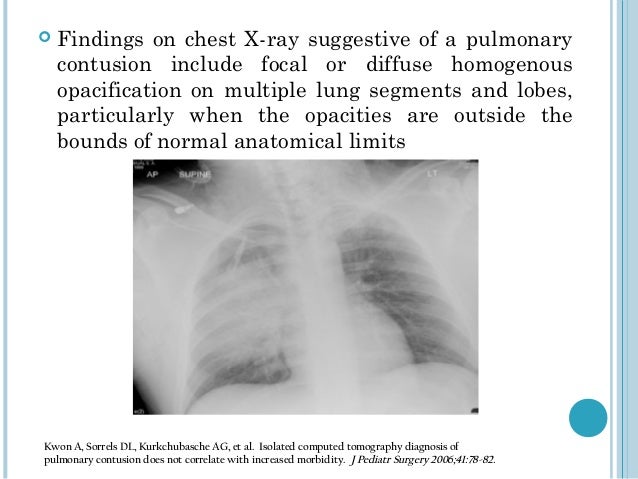 12100053 pulmonary contusion