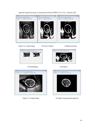 ROLE OF HYBRID LEVEL SET IN FETAL CONTOUR EXTRACTION | PDF