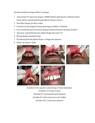 121341358 frenektomi | DOC