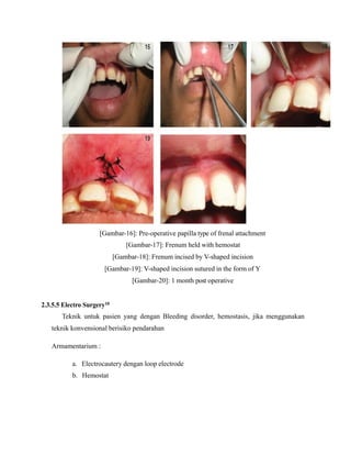 121341358 frenektomi | DOC