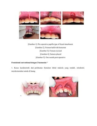 121341358 frenektomi | DOC