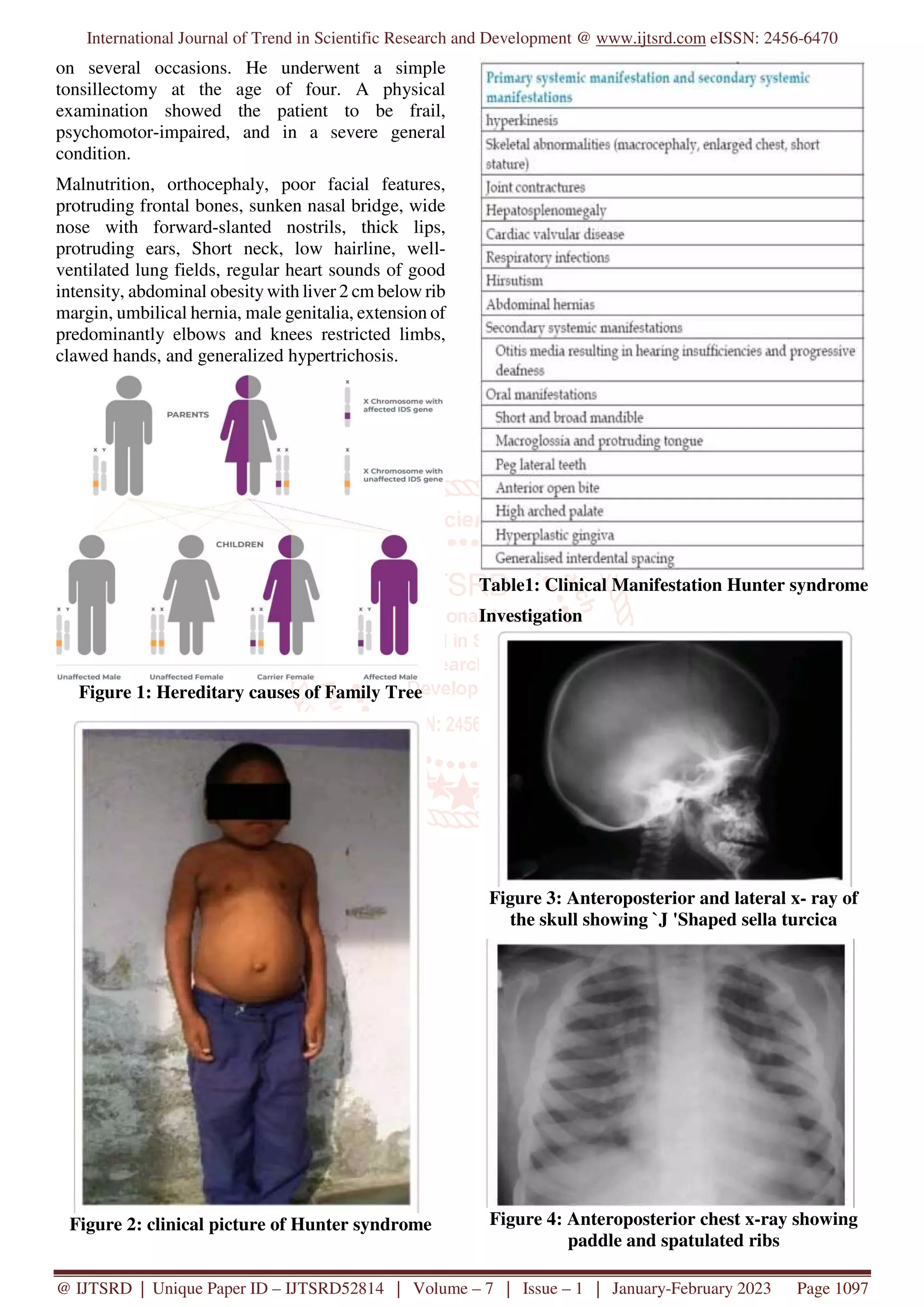 Hunter Syndrome A Case Report | PDF