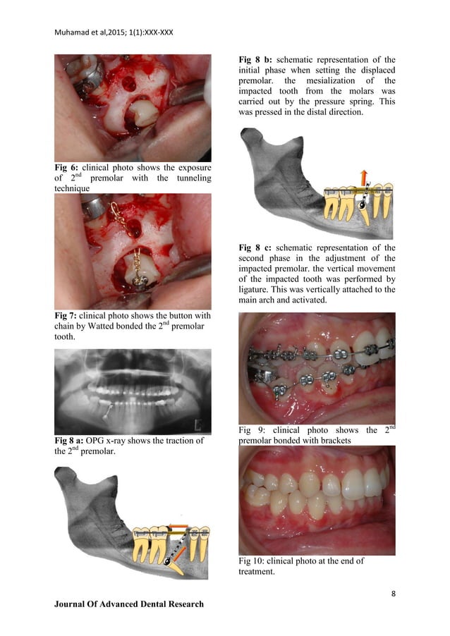 MANAGEMENT OF LOWER SECOND PREMOLAR IMPACTION | PDF | Dental Health ...