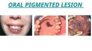 Oral Pigmented Lesions: Clinical, Histopathological and Diagnostic ...