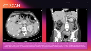 BILIARY TREE RADIOLOGY ADVANCE IMAGING (USG, CT SCAN, MRI AND ERCP) OF ...