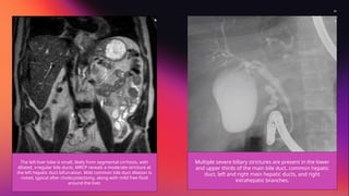 BILIARY TREE RADIOLOGY ADVANCE IMAGING (USG, CT SCAN, MRI AND ERCP) OF ...