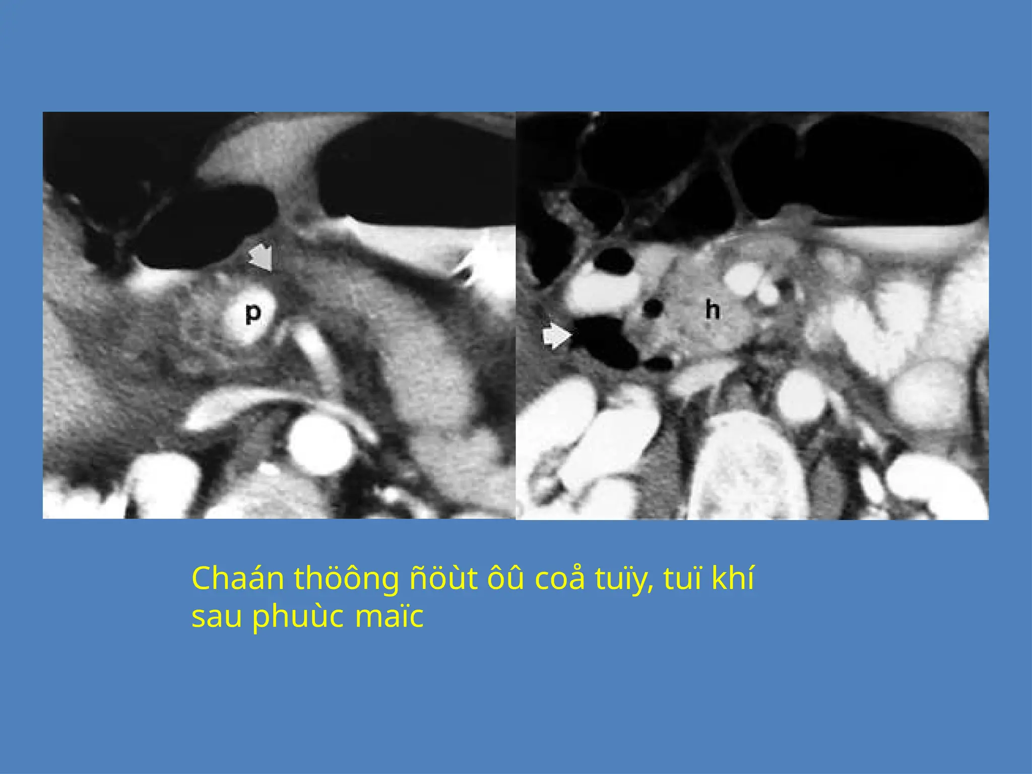 [123doc] - tai-lieu-ct-benh-ly-tuy-pptx.pptx