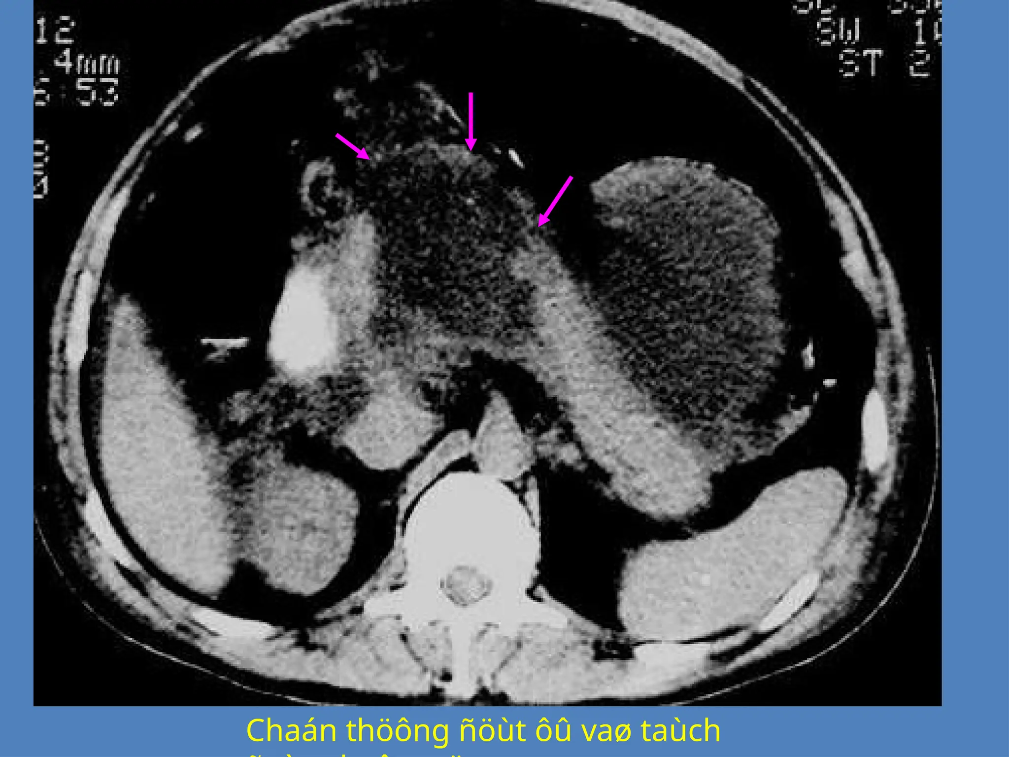 [123doc] - tai-lieu-ct-benh-ly-tuy-pptx.pptx