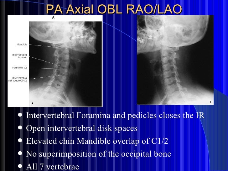 Cervical spine oblique x ray positioning - partiesrolf