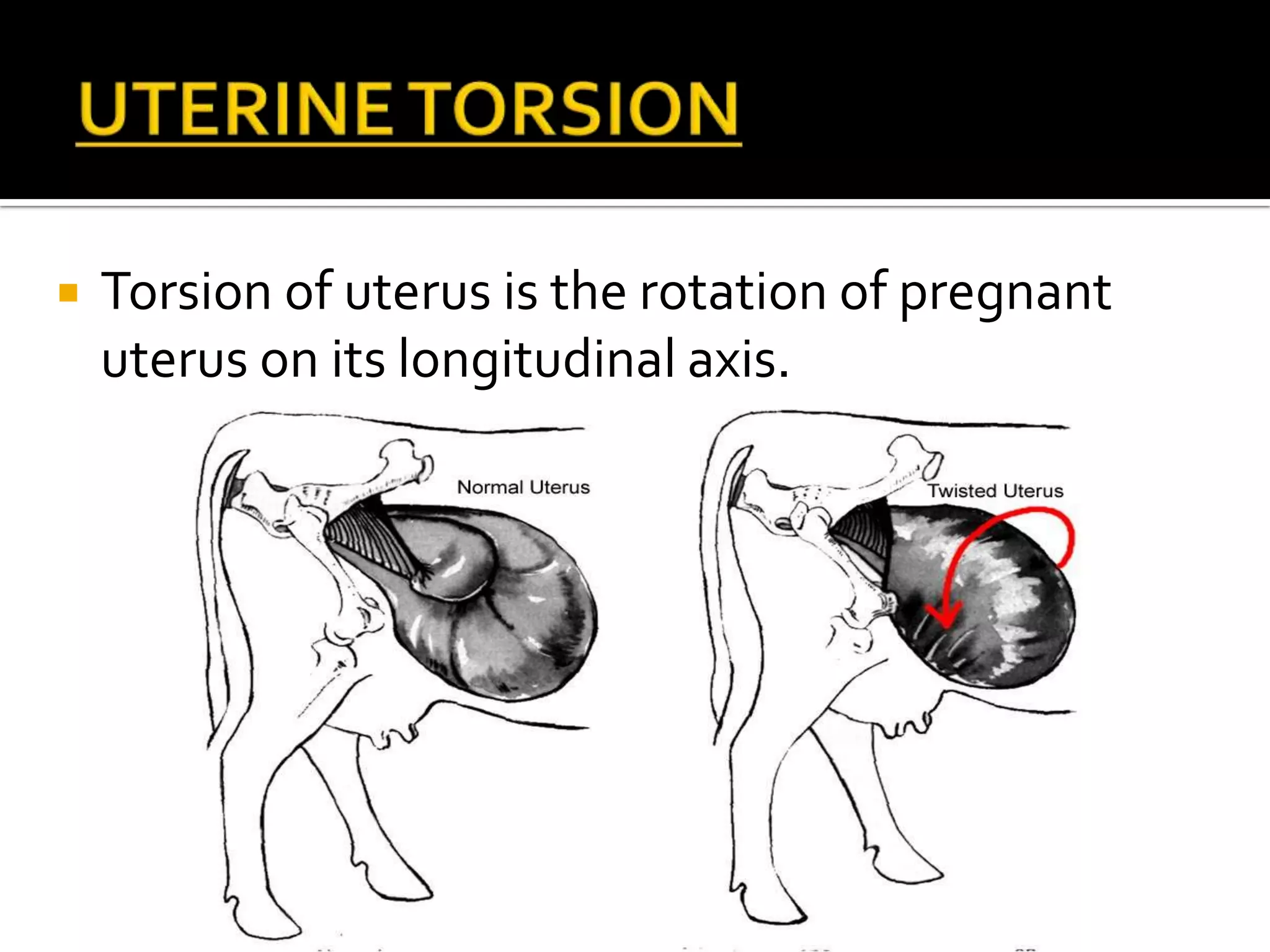 UTERINE TORSION | PPTX
