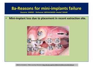 126 failure mini-implant-miniscrews in orthodontics-case report-oussama ...